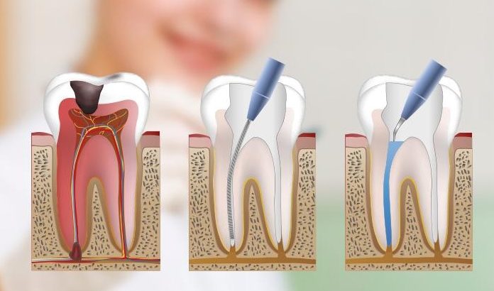 Signs and Symptoms for Root Canal Therapy | Dentist Canberra